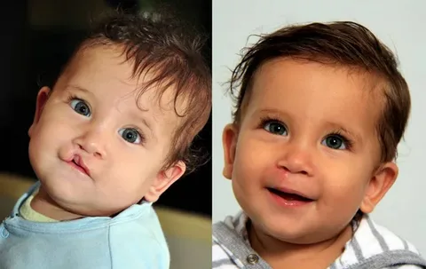 La operación del labio leporino | Blog Cirugía Estética y Plástica Peru