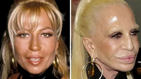 Consecuencias del botox | Blog Cirugía Estética y Plástica Peru