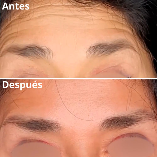 Botox Ojos Antes Y Después
